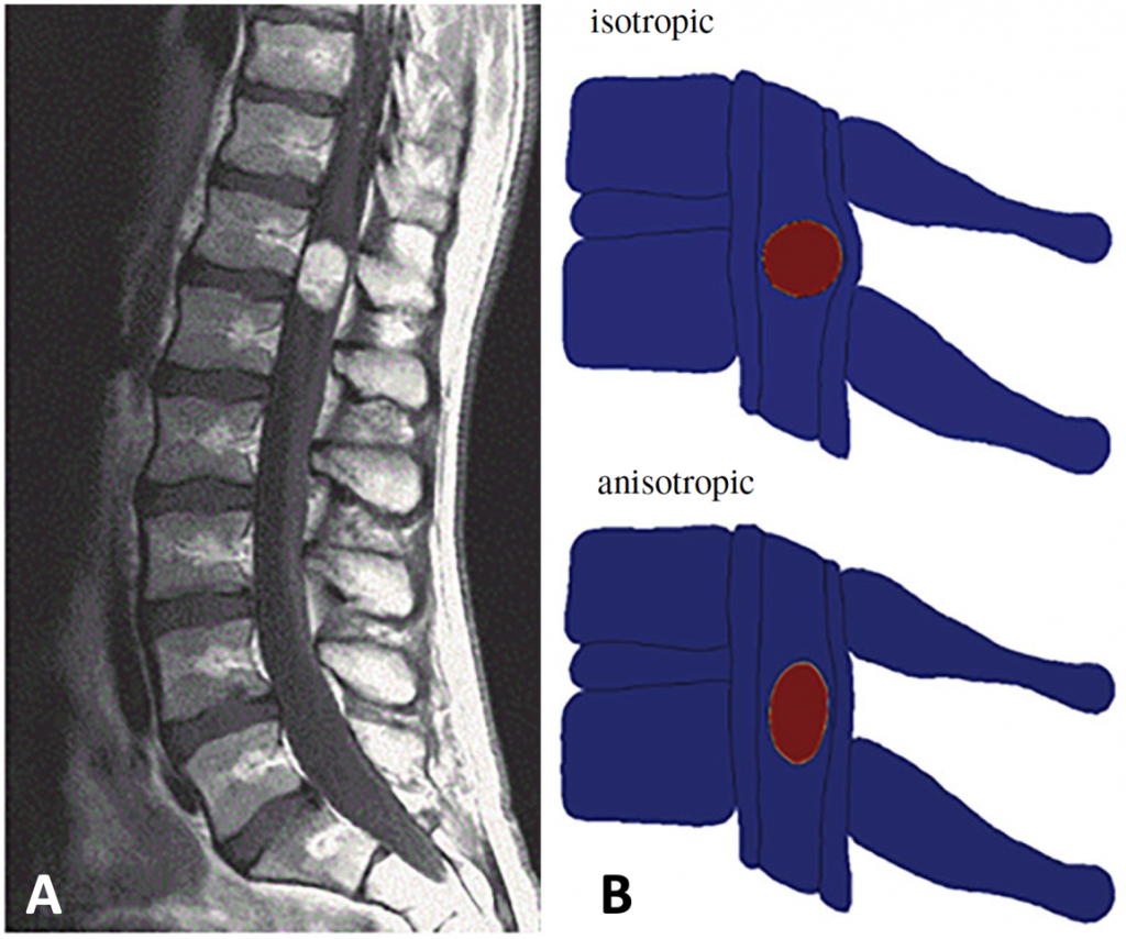 Brain/Spine model for cancer mechanobiology – multiscale simulations ...